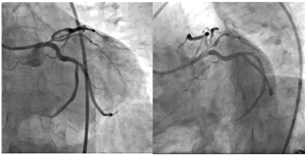 Trifurcated lesion에서 Successful PCI