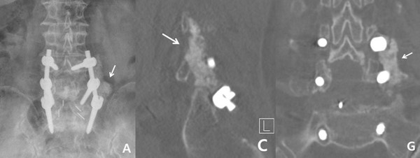 E.BMP-2 ‘노보시스’, 환자 골 유합 촉진에 도움