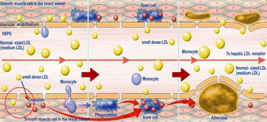 "심혈관질환의 숨은 주범 ‘sdLDL 콜레스테롤’, 미리 검사해야"